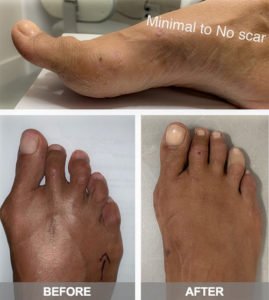 Minimally Invasive Foot Surgery | Minimal Incision Surgery for Foot ...