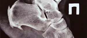 Heel, Toe Bone Spurs Specialists in NYC · Manhattan Foot Specialists