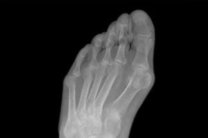 Cheilectomy · 2022 Top Foot Doctor, Podiatrist in NYC