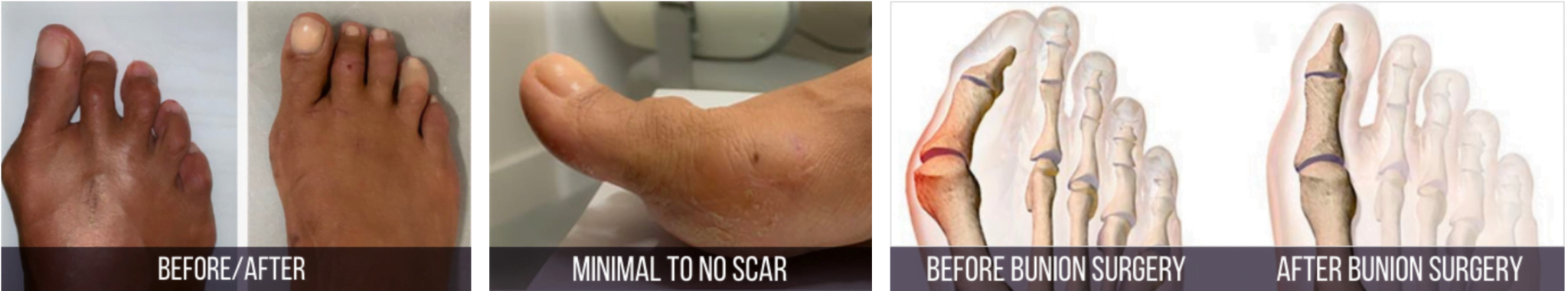 Bunion Surgery Manhattan | NYC Best Bunion Removal Surgeon